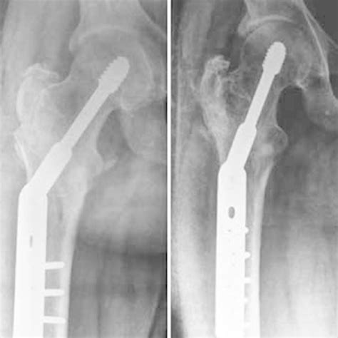 The Pipkin Classification A Type I Femoral Head Fracture Inferior