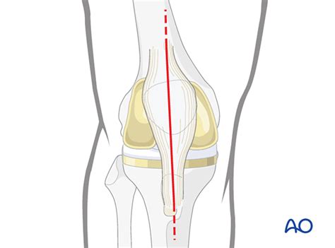 Proximal Tibia Replacement For Fracture Around A Loose Tibial Component With Good Bone Stock