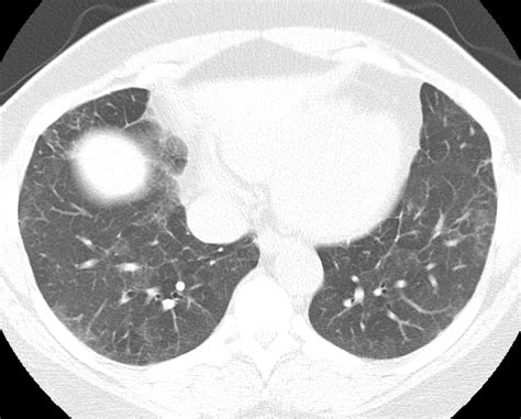 150lu Progressive Ild Uip Vs Fibrotic Nsip Lungs