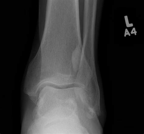 Ossifying Fibroma Tibia