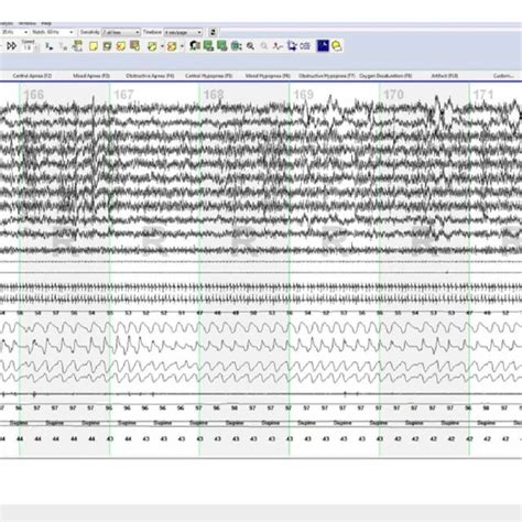 Polysomnogram With The Vns Turned Off Did Not Reveal Any Obstructive Or