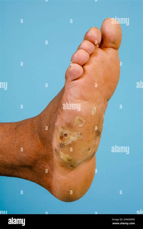 Close Up Of The Foot Of A Mycetoma Sufferer Mycetoma Is An Uncommon Close Up Of The Foot Of A Mycetoma Sufferer Mycetoma Is An Uncommon