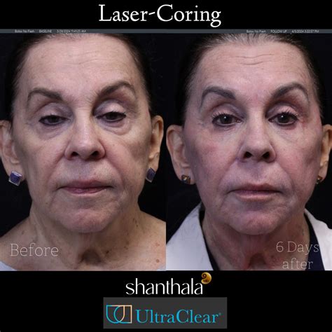 Laser Coring Before After Photos Boston Dr Shanthala