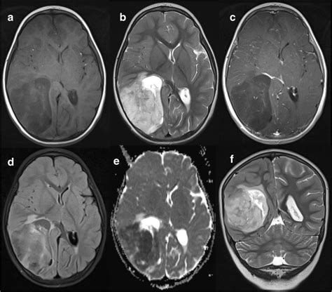Preoperative Magnetic Resonance Imaging Mri Axial Precontrast