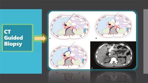 Ct Guided Biopsypptx