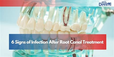 What If An Infection Comes Back After A Root Canal Arch Dental