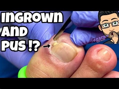 EXTRACTION OF AN INGROWN TOENAIL WITH PUS YouTube