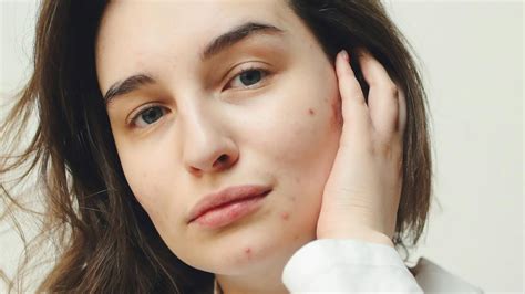 Akné Pred Menštruáciou Lekárka Radí Ako Ho Zmierniť