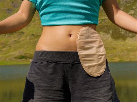 The 5 Most Common Types Of Colostomy Pouches Inspiring Dreams