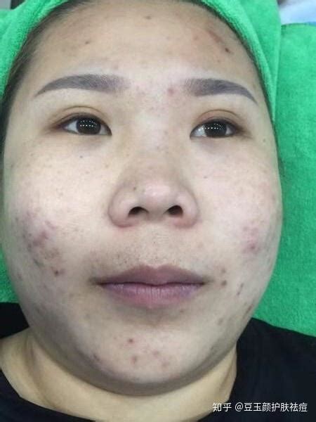 豆玉颜 你知道痘根是什么吗痘根应该怎么去除 知乎