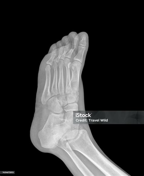 X Ray Of Skeleton Of Foot Human Foot Bones Anatomy Of Joints Foot