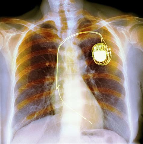 Dual Chamber Pacemaker Photograph By Science Photo Library My Xxx Hot