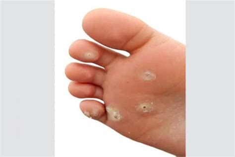 Warts Treatments At Dr Al Rustom Skin And Laser Center