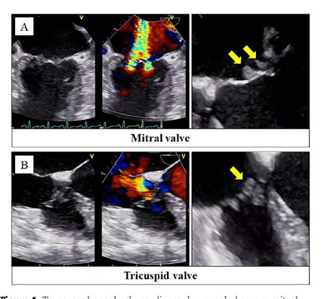 Figure 1 From Postoperative Anticoagulation Management Using Subcutaneous Unfractionated Heparin