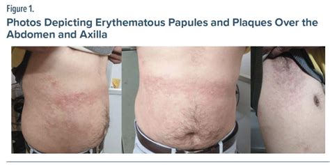 Vinegar Induced Disulfiram Reaction