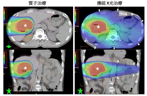 記者 梅花新聞網 田瑜萍台北報導 長庚癌症治療再突破：質子治療有效控制大型肝癌 延長存活 ｜ 梅花新聞網
