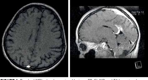 Figure 1 From Anti Nmda Receptor Encephalitis In A Young Woman A