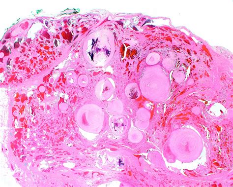Spindle Cell Hemangioma