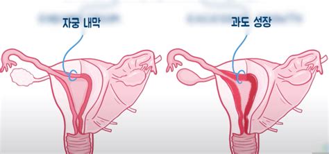 자궁내막 증식증 원인과 증상 치료 자궁내막 두꺼움 네이버 블로그