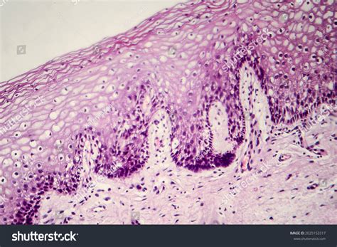 Cancer Cervix Light Micrograph Cervical Biopsy Stock Photo Shutterstock