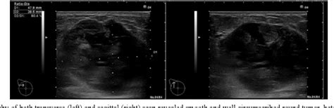 Figure 1 From An Extremely Rare Malignant Glomus Tumor Of The Breast A