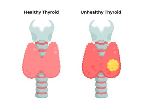 Thyroid And Neck Tumor Surgery Tijuana Surgery Center