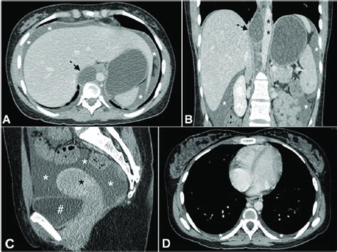 Thoracic And Abdominal Enhanced Computed Tomography A Axial Plane And