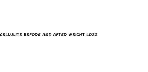Cellulite Before And After Weight Loss
