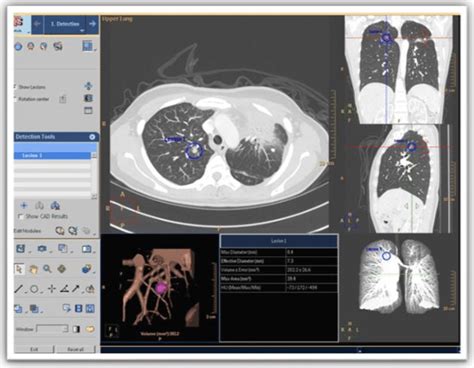 Computer Aided Detection Of Chest Nodules Philips 2018 Download
