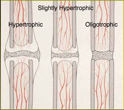 Fracture Complications Flashcards Quizlet