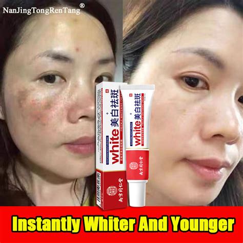 【100 Genuine】whitening Freckles Cream Effective Freckle Whitening