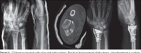 Figure 3 From Fragment Specific Fixation For Complex Intra Articular