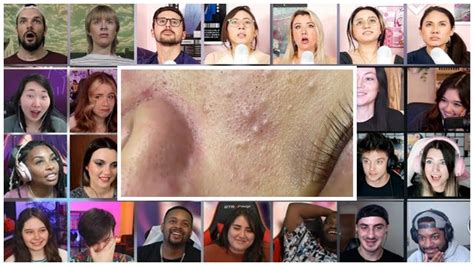 Cystic Blackheads Extraction New This Week Dr Mozan Most Disturbing