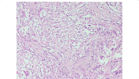 Patternless Array Of Proliferated Bland Spindle Shaped Cells Set In A