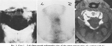 Figure 1 From Occipital Neuralgia And The C1 2 Arthrosis Syndrome Semantic Scholar