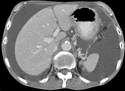 A 55 Year Old Male Patient Presented With Abdominal Pain And