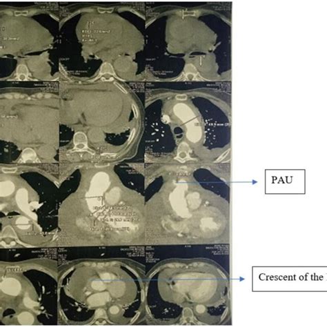 Thoracic Angioscanner Showing A Dilated Thoracic Aorta Without Intimal Download Scientific