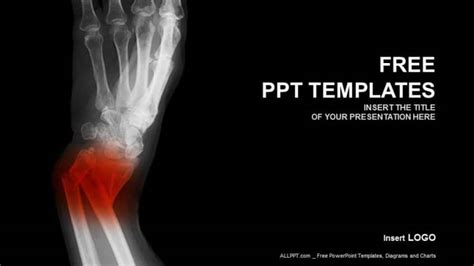 Free Broken Forearm X Ray Powerpoint Template Designhooks