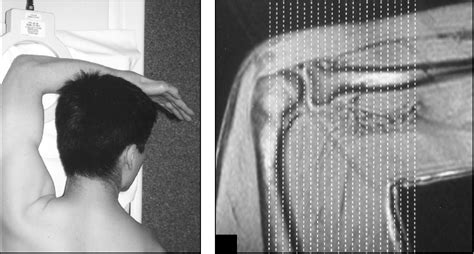Figure 2 From Optimal Positioning For Mri Of The Distal Biceps Brachii