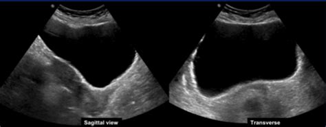 Nephro And Gu Pocus Flashcards Quizlet