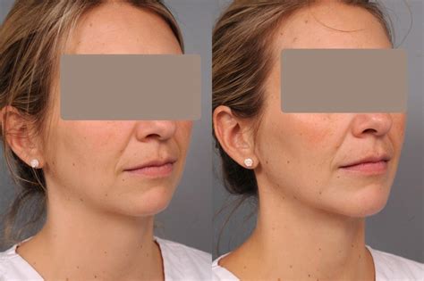 Neck Smartlipo™ Liposuction With Chin Implant In New York