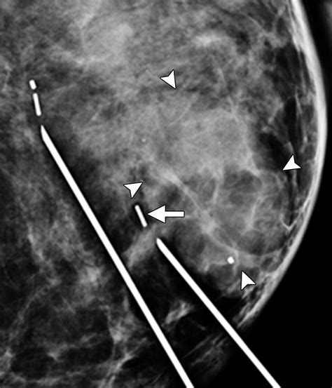 Magnetic Seed Lumpectomy At Harrison Trethowan Blog