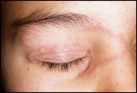 7 Causes And Effective Home Remedies To Get Rid Of Eyelid Rashes 2025