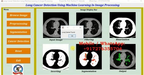 Lung Cancer Detection Using Machine Learning Technique Matlab Project Source Code ENGINEERING