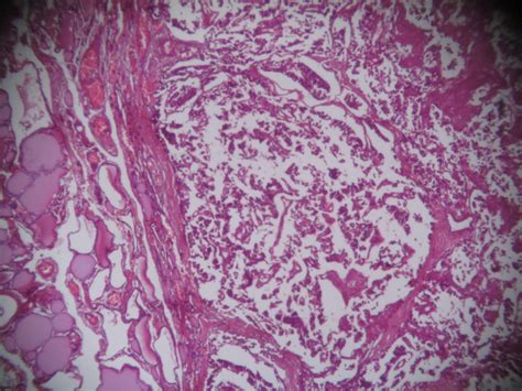 Medullary Carcinoma Thyroid Histopathologyguru