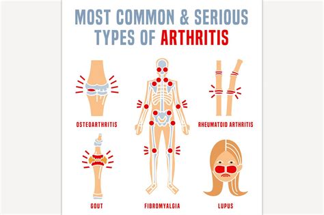 Arthritis Types Infographic Icons ~ Creative Market