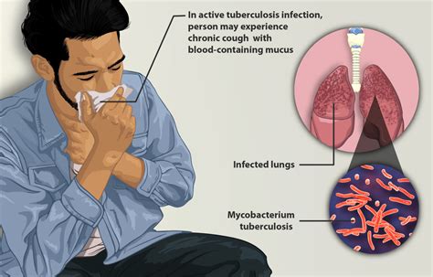 Tuberculoza TBC Simptome Si Metode De Tratament BodyGeek