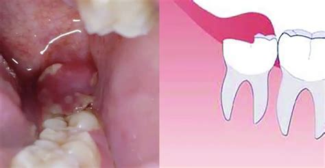 Can Wisdom Tooth Cause Swollen Lymph Nodes