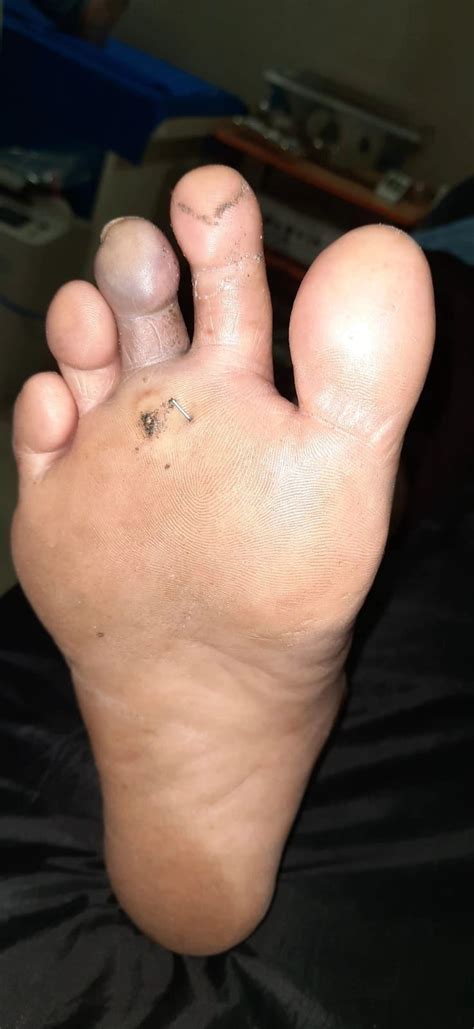 Dr Ashish Shukla On Linkedin Savefeet