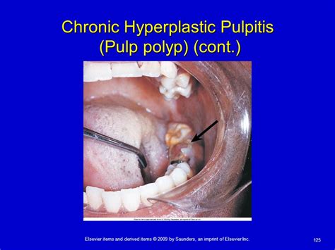 Chronic Hyperplastic Pulpitis Jaypeedigital Ebook Reader